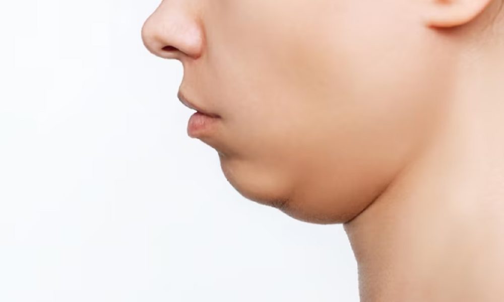 Cara Hilangkan Double Chin agar Miliki Dagu yang Ideal : e-Kompas.ID ...